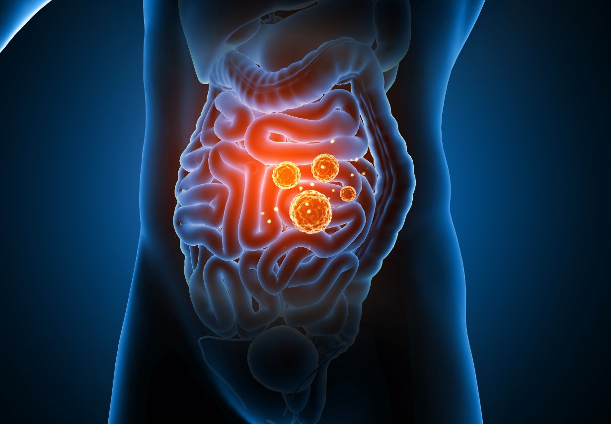 Irritable bowel syndrome (IBS) and gut dysbiosis: a logical ...